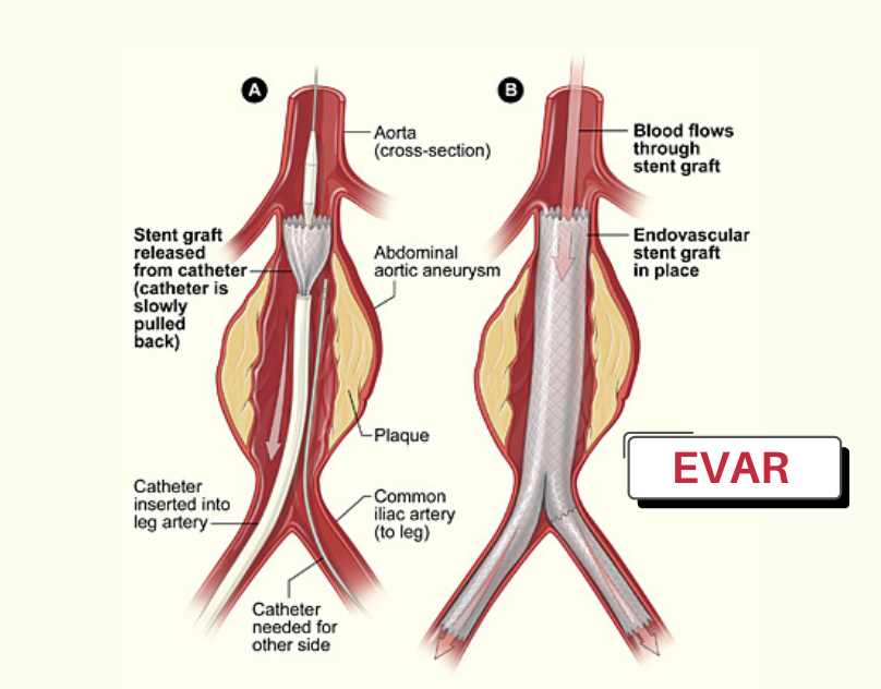 Aortic Stent Graft My Blog